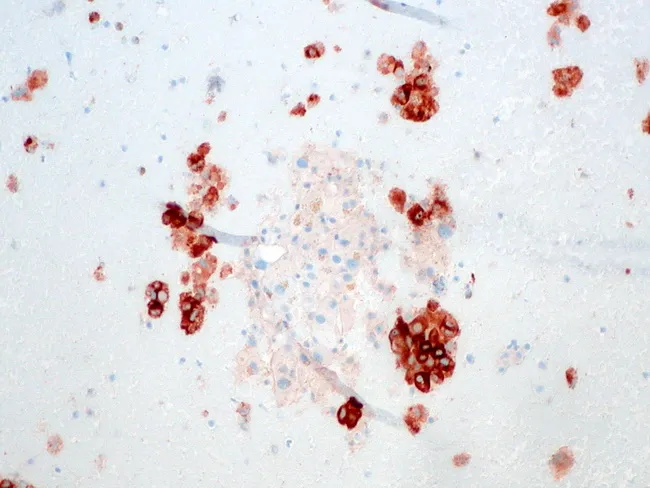 Melanoma Immunohistochemistry : HMB-45