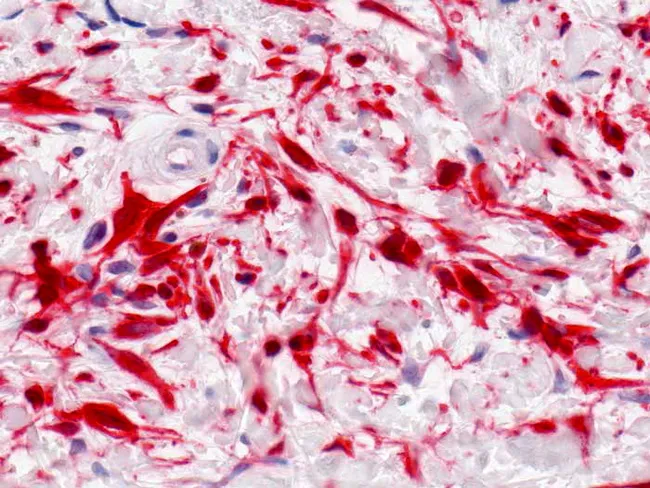 Melanoma Immunohistochemistry : Melan-A
