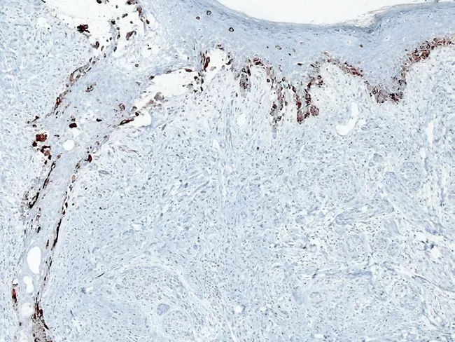 Melanoma Immunohistochemistry : Melan-A