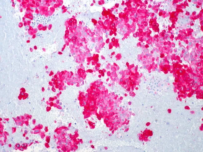 Melanoma Immunohistochemistry : Melan-A