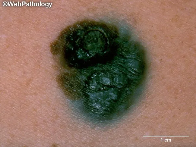 Superficial Spreading Melanoma