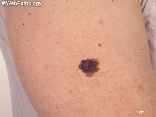 Superficial Spreading Melanoma