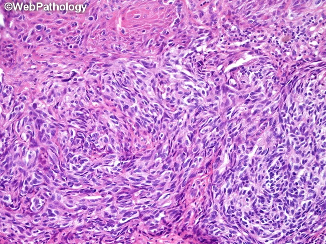 Superficial Spreading Melanoma