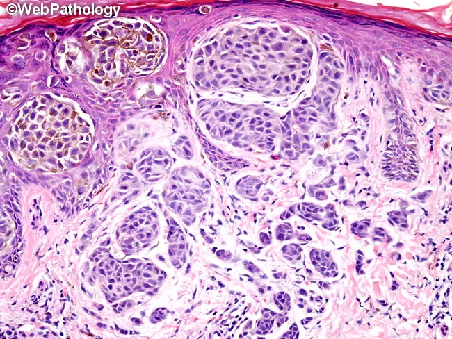 Superficial Spreading Melanoma