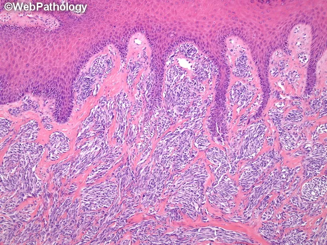 Histologia Do Melanoma Lentiginoso Acral Avaliando Aprendizado
