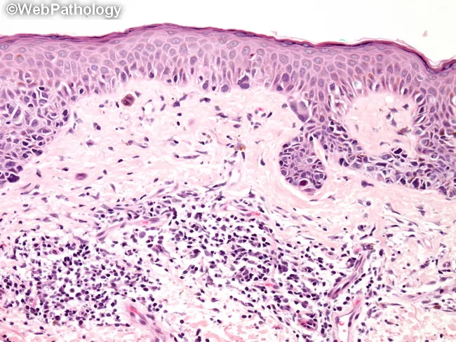 lentigo maligna guidelines