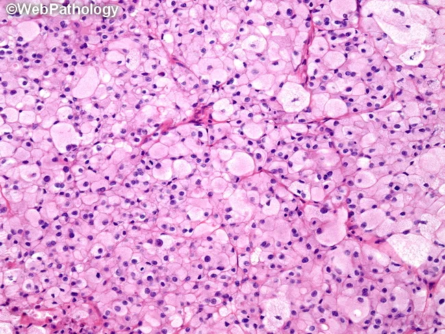 Balloon Cell Melanoma