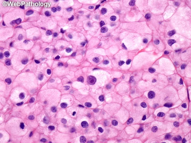 Balloon Cell Melanoma