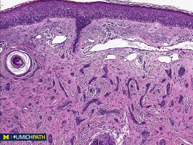 Desmoplastic Trichoepithelioma