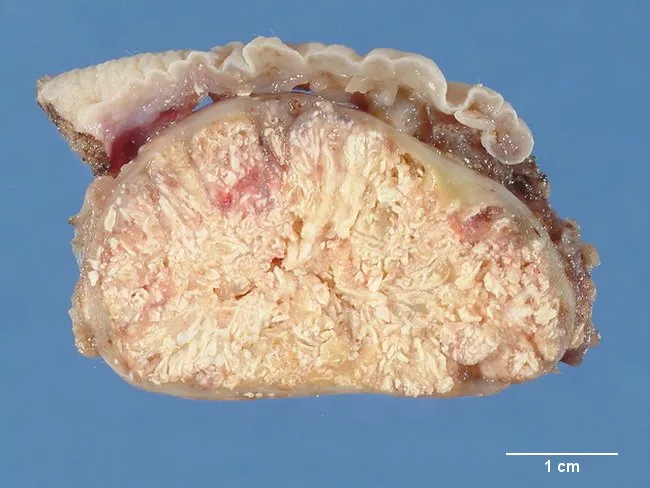 Pilomatrixoma : Gross Pathology