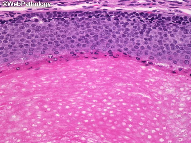Pilomatricoma Histology Pathology Outlines
