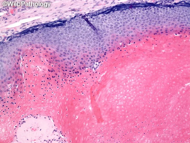 Pilomatricoma Histology Pathology Outlines