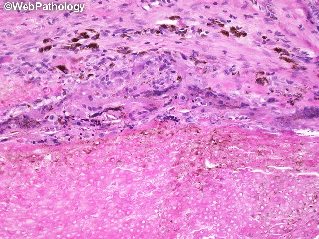 Pilomatrixoma : Treatment