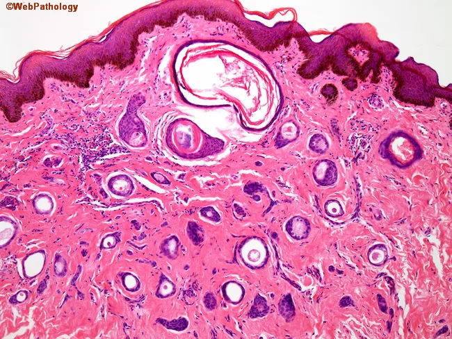 syringoma skin histology