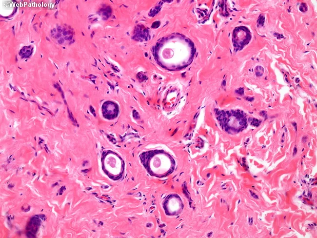 syringoma skin histology