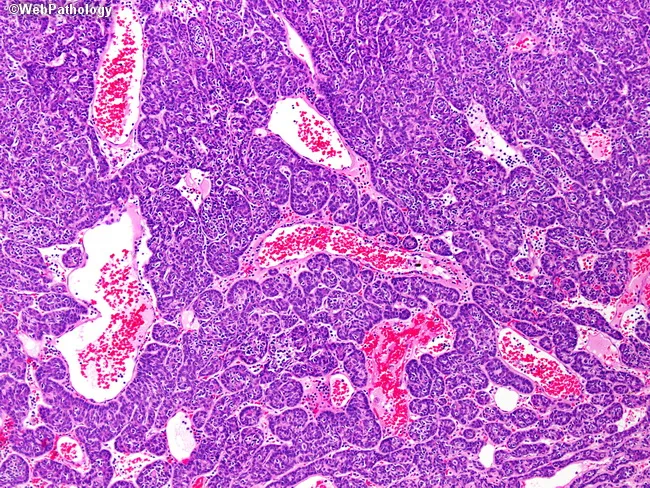 Eccrine Spiradenoma