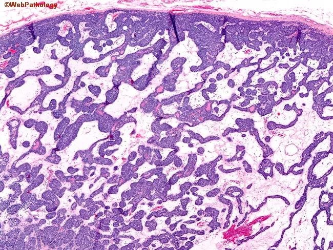 Eccrine Spiradenoma