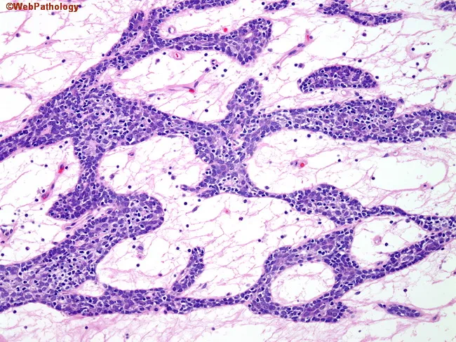 Eccrine Spiradenoma