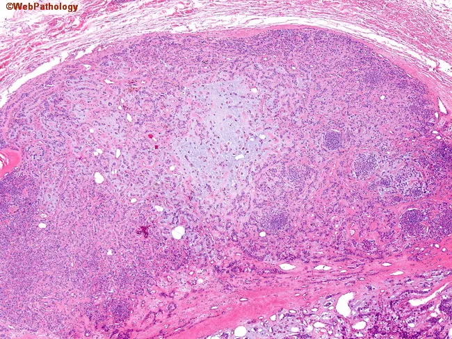 Mixed Tumor of Skin (Chondroid Syringoma)