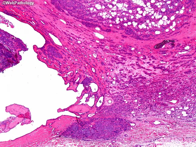 Mixed Tumor of Skin (Chondroid Syringoma)