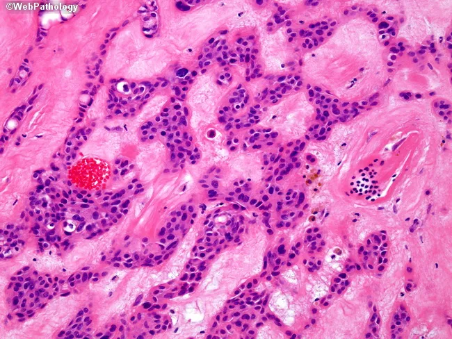 Mixed Tumor of Skin (Chondroid Syringoma)