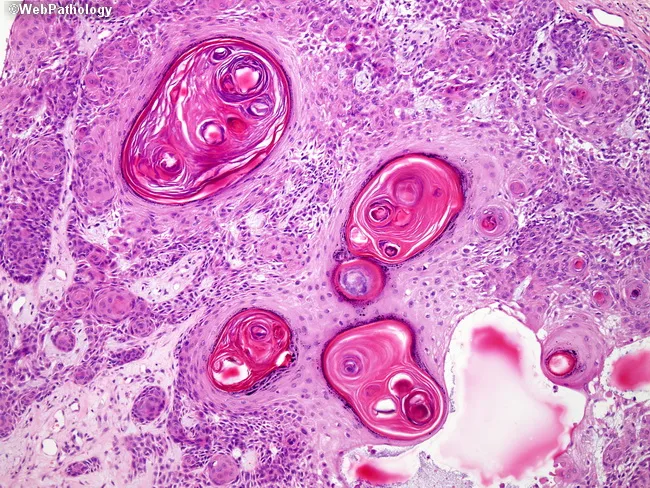 Mixed Tumor of Skin (Chondroid Syringoma)