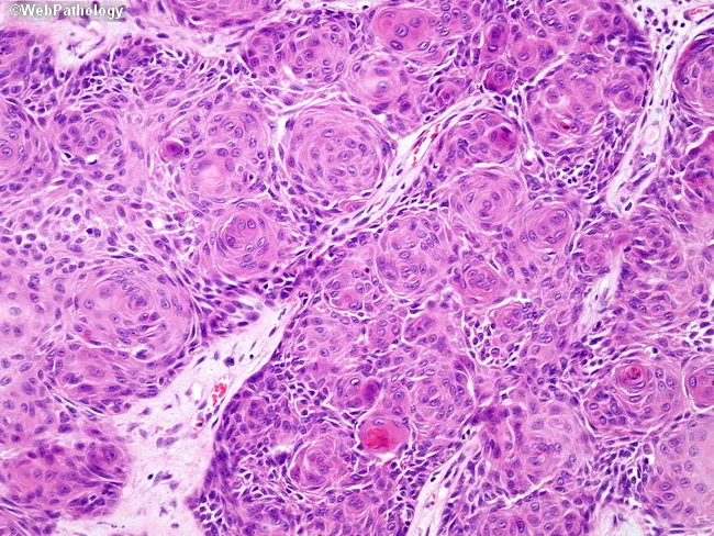 Mixed Tumor of Skin (Chondroid Syringoma)