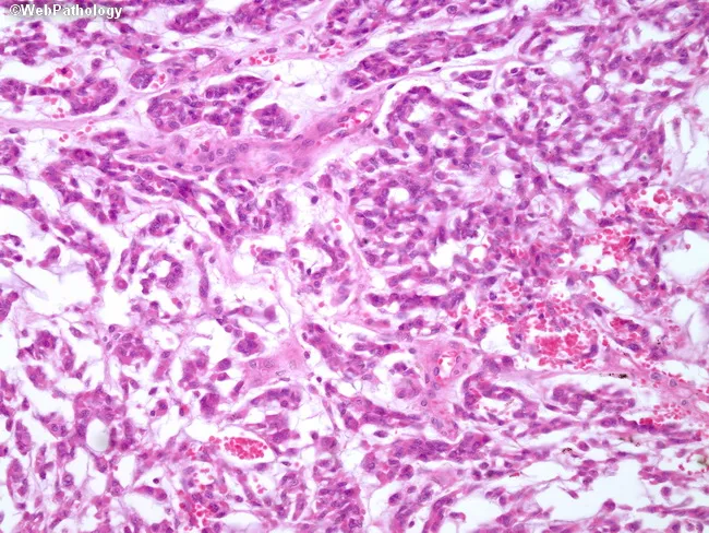 Mixed Tumor of Skin (Chondroid Syringoma)
