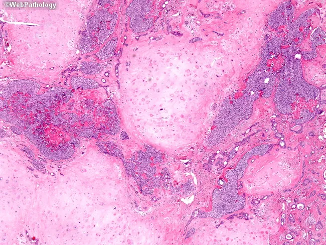 Mixed Tumor of Skin (Chondroid Syringoma)