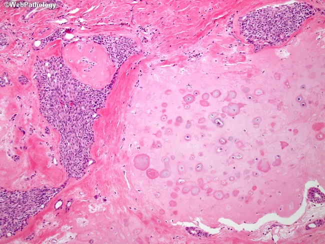 Mixed Tumor of Skin (Chondroid Syringoma)