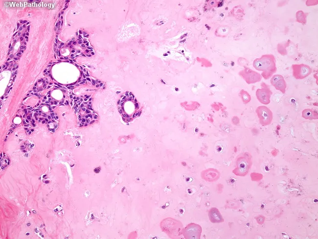 Mixed Tumor of Skin (Chondroid Syringoma)