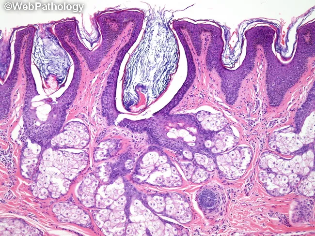 Nevus Sebaceus