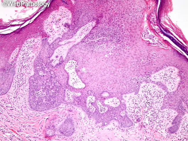 Nevus Sebaceus