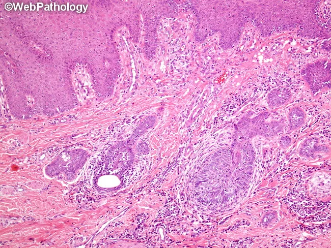 Nevus Sebaceus