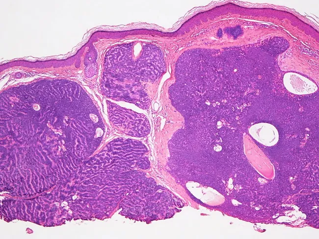 Sebaceoma