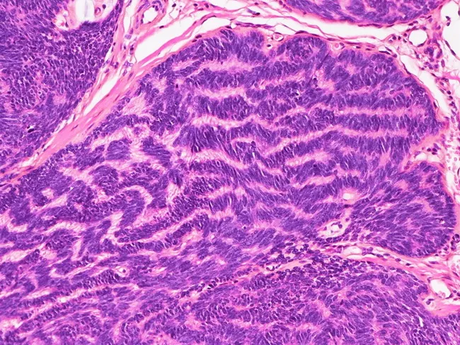 Sebaceoma