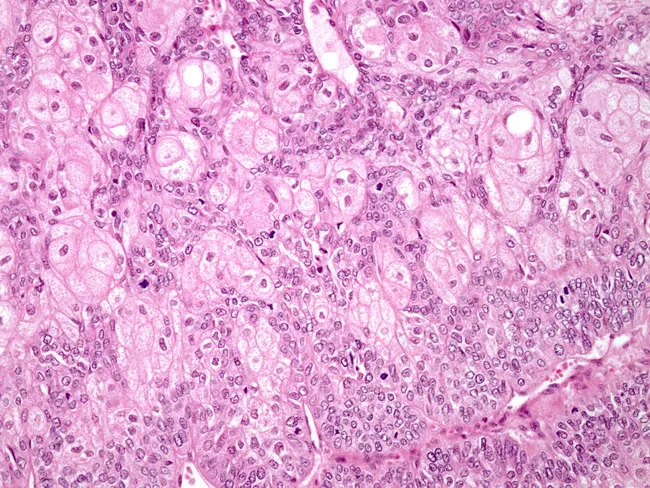 Sebaceous Carcinoma : Prognosis