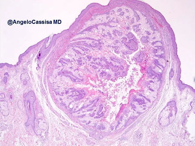 Sebaceous Adenoma in Muir-Torre Syndrome