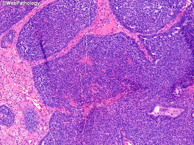Adenoid Cystic Carcinoma of Breast : Basaloid