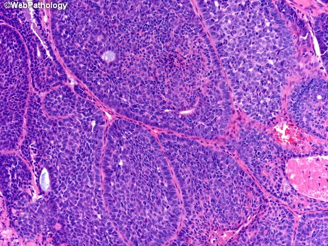 Adenoid Cystic Carcinoma of Breast : Basaloid