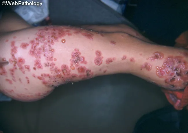 c3 dermatosis