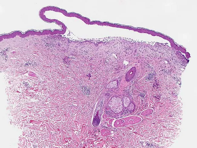 Dermatitis Herpetiformis
