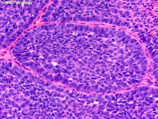 Adenoid Cystic Carcinoma of Breast : Basaloid