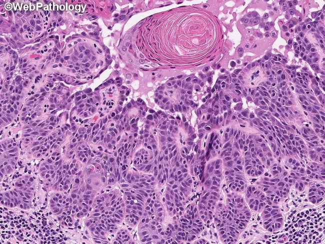 Darier Disease