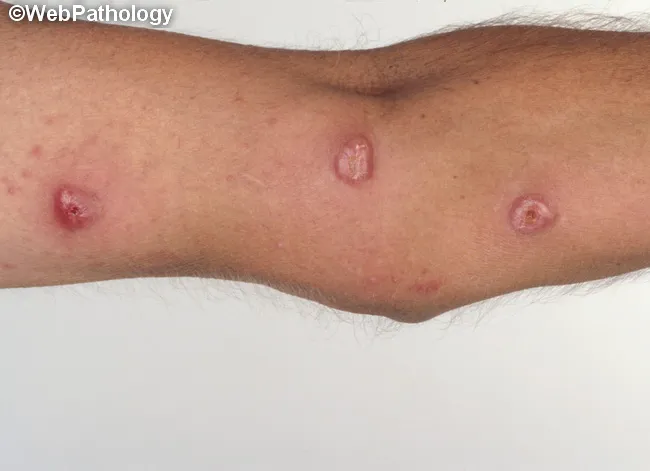 Arthropod Bite Reaction