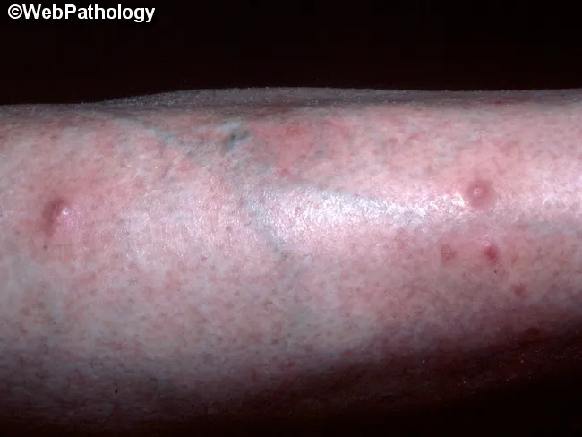 Arthropod Bite Reaction