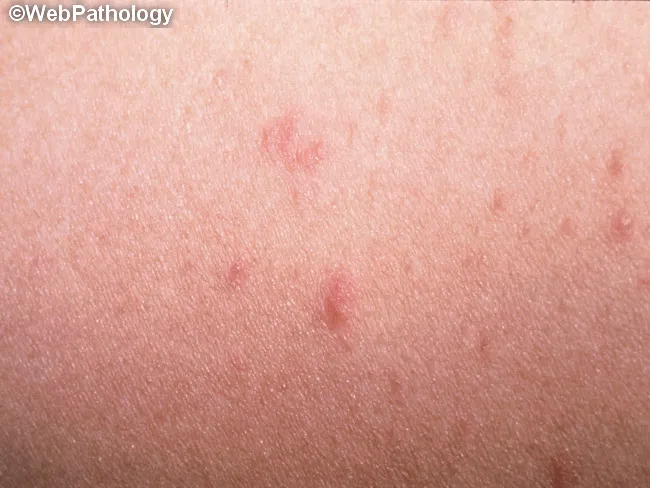 Arthropod Bite Reaction