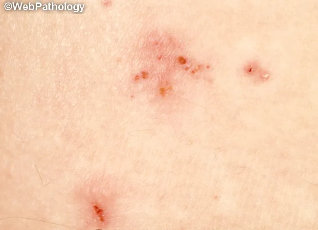 Arthropod Bite Reaction