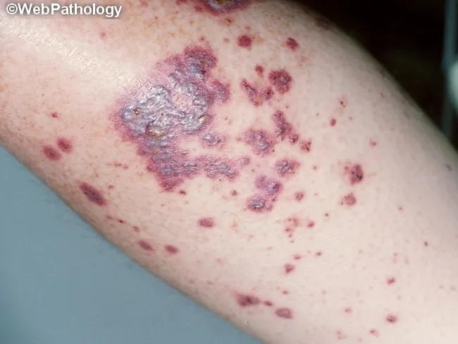 Drug reaction : Cefadroxil