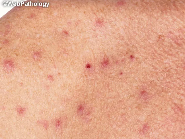 Drug reaction : Furosemide